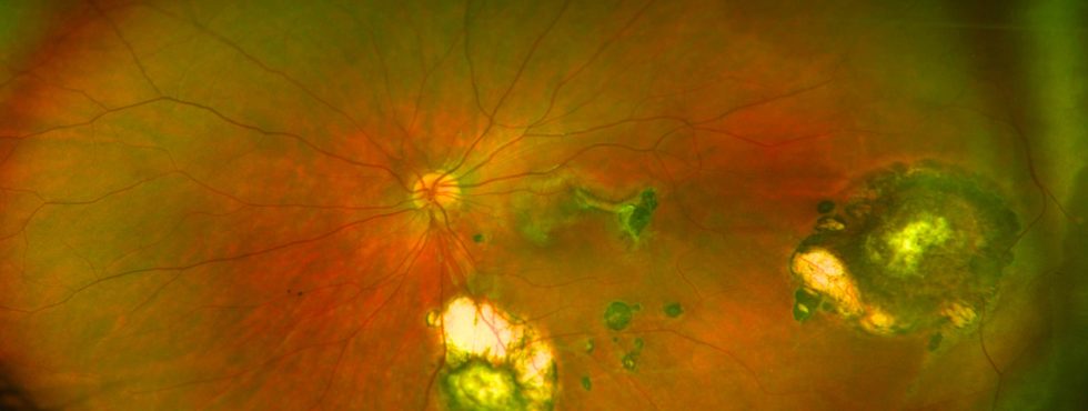 Toxoplasmosis @ Retina Orange County