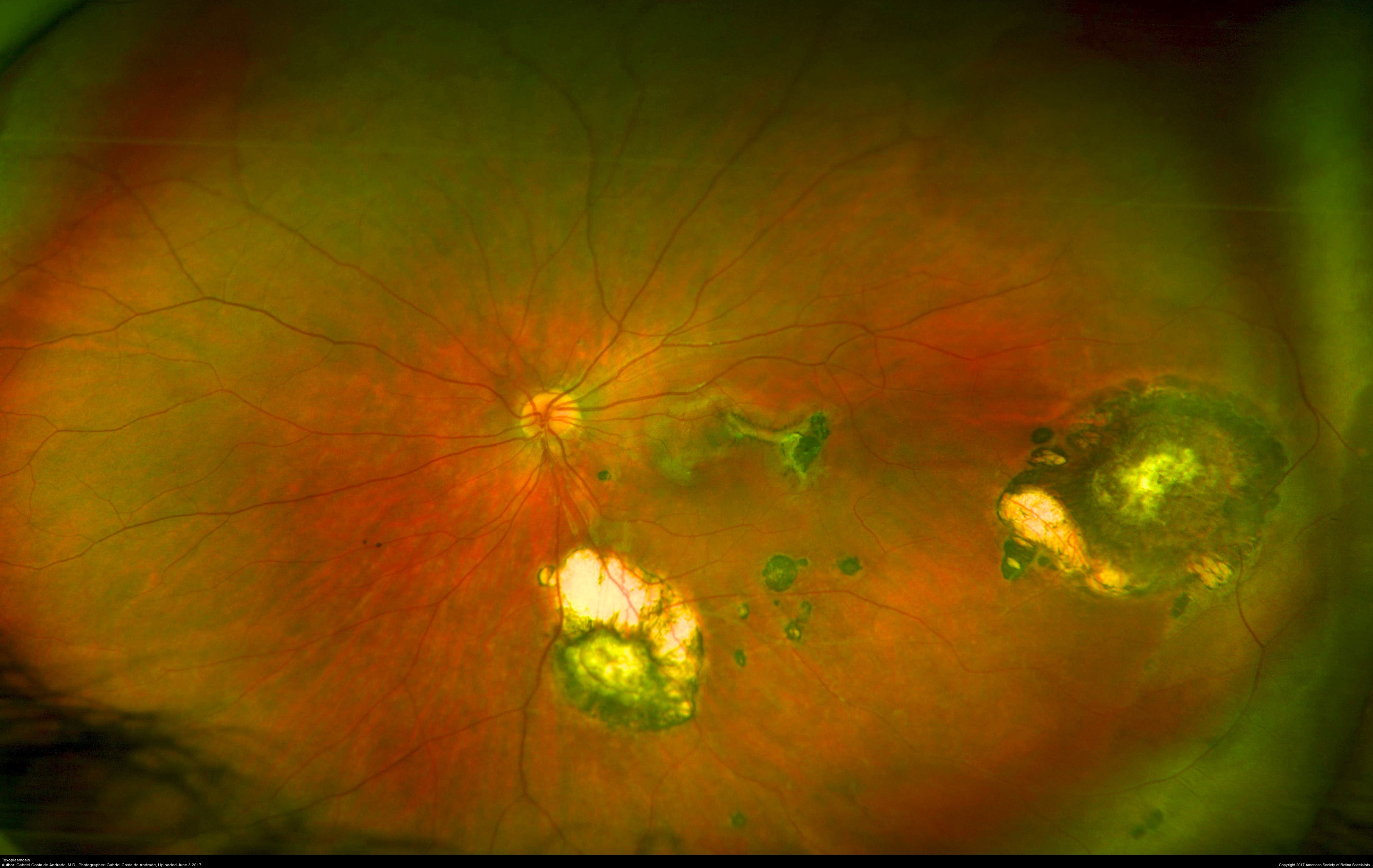 ASRS-RIB-Image-27230 – Retina Orange County